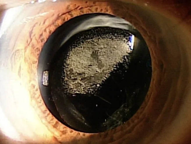 Đục bao sau (Posterior Capsular Opacification) - BỆNH VIỆN MẮT SÀI GÒN ...